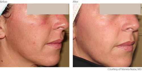 Lumenis® M22™ ResurFX™ Laser Treatment - Total Med Solutions